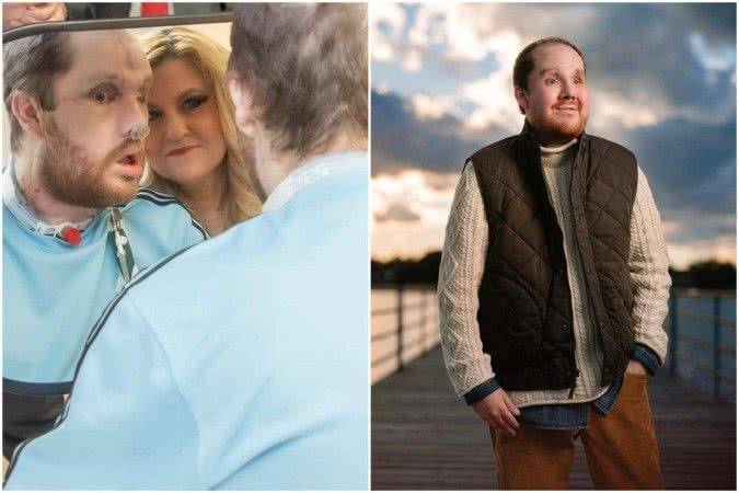 Homem recebe transplante de face após ter rosto desfigurado por tiro