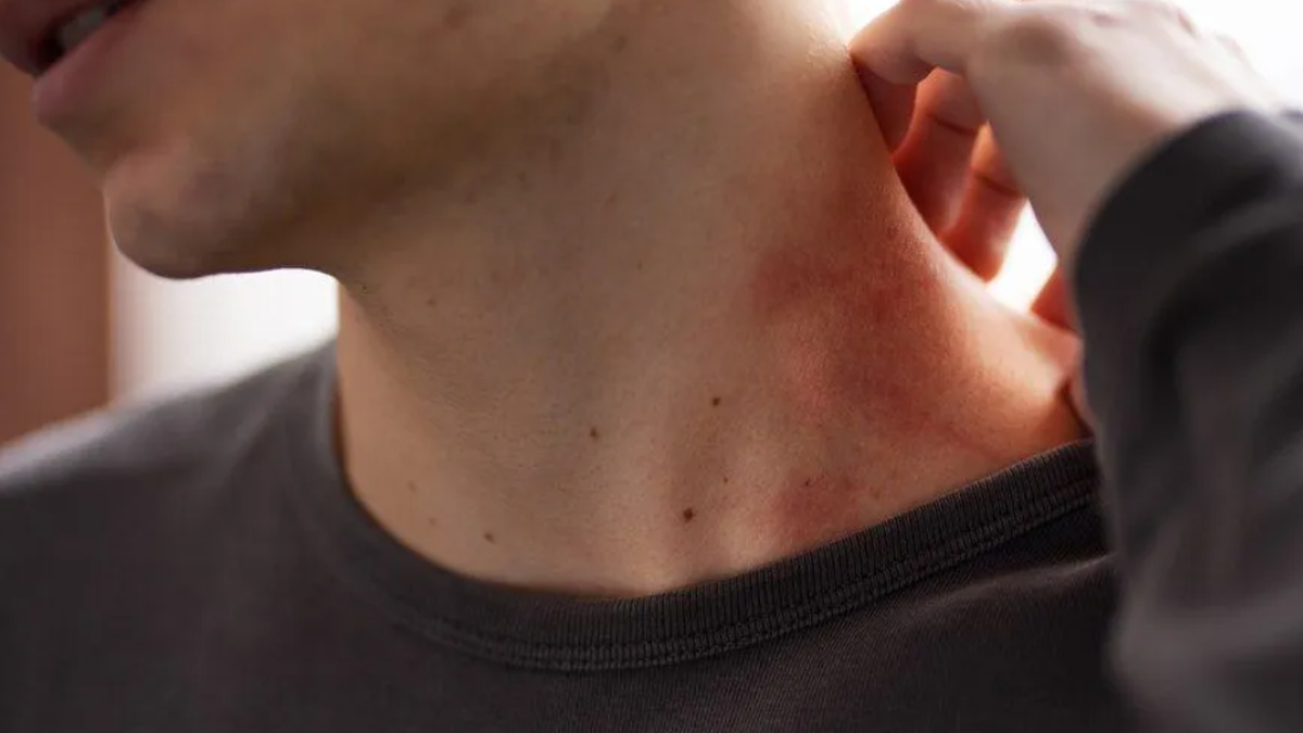 Picada de percevejo faz mal? Veja sintomas e como cuidar