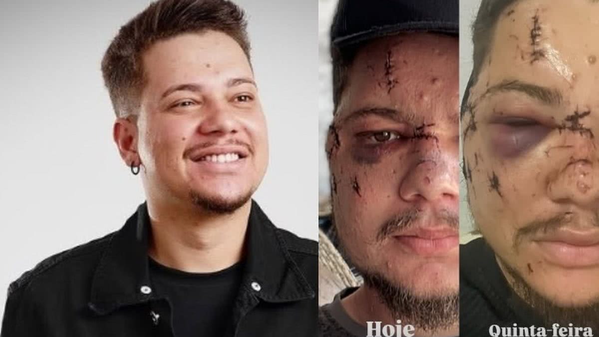 Sertanejo é agredido em show, leva 30 pontos e fica com o rosto desfigurado