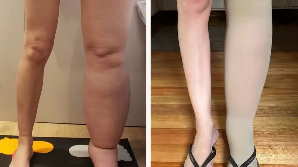 Linfedema: cabeleireira de SC relata saga de décadas com doença que ...