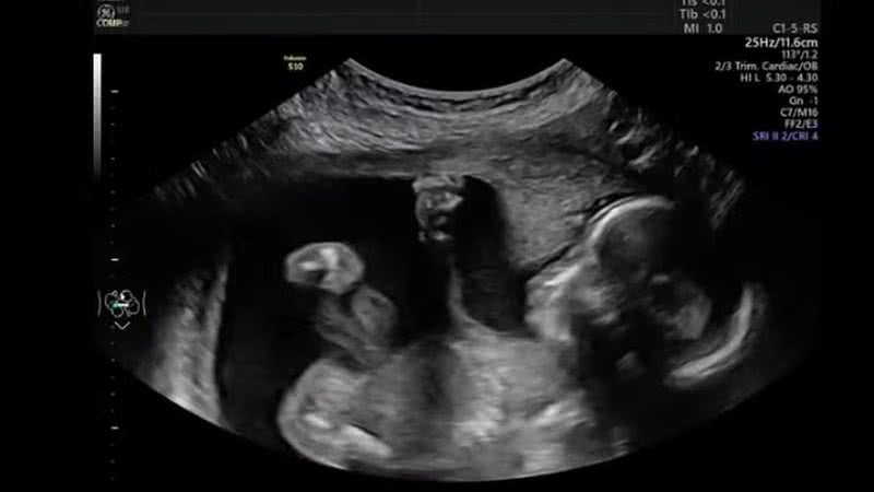 Bebê é vista 'dando soco' na mãe durante exame de ultrassom ...