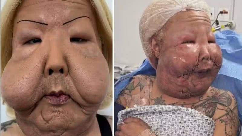 Influenciadora Juju do Pix passará por nova cirurgia para retirar óleo mineral do rosto