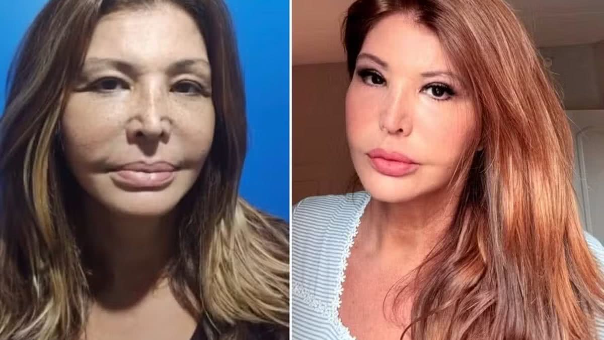 Roberta Close recorre à harmonização facial aos 60 anos; veja resultado