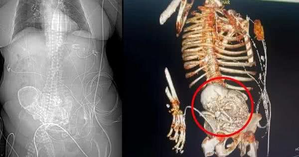 'Bebê de pedra': idosa de 86 anos descobre feto calcificado que ...